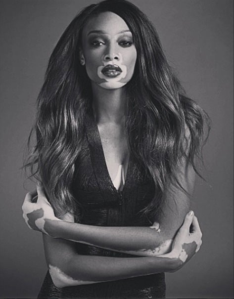 Winnie Harlow, la primera modelo con vitíligo | Diario Sur