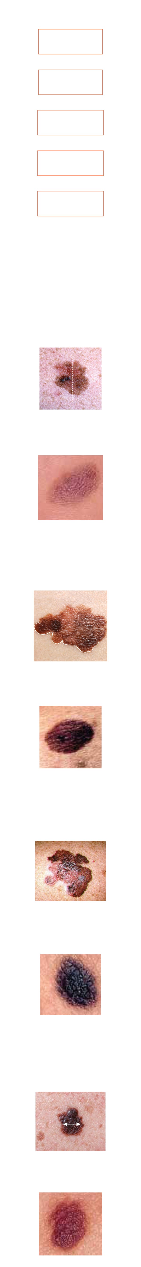 25.000 guipuzcoanos tienen melanoma, el tipo de cáncer de piel más ...