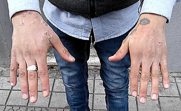 Los rastreadores del covid se incorporan al control de la sarna en ...