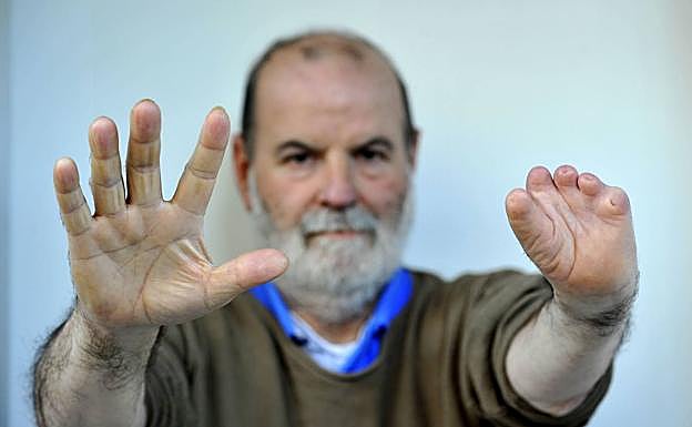 Regresa a España la talidomida, el fármaco maldito que provocó ...