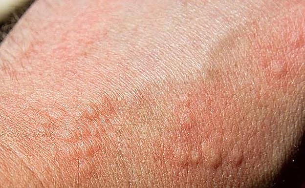 Lo explica una dermatóloga: la urticaria, un problema cada vez más ...