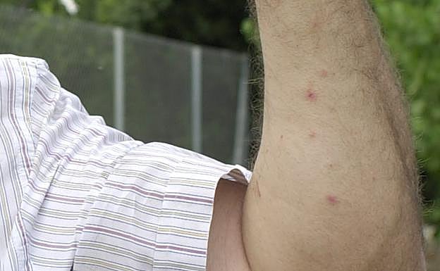 ¿Qué me ha picado? | Cómo tratar la mordedura de la mosca negra | Las ...